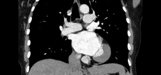 Revolution Apex CT System | GE Healthcare UK | GE Healthcare