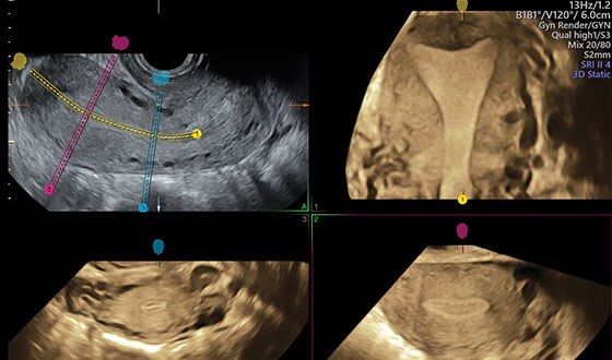 Voluson E8 | GE Healthcare