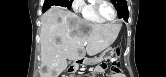 Revolution Apex CT System | GE Healthcare UK | GE Healthcare