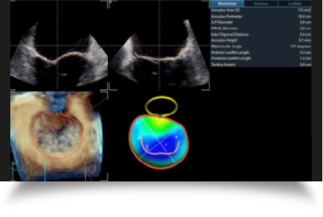 Heart Care Structural | GE Healthcare