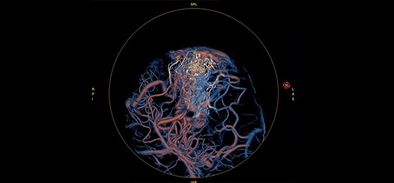 Embo ASSIST | GE Healthcare