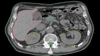 Auto Segmentation | GE HealthCare (United Kingdom)