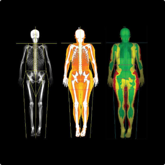 Bone and Metabolic Health Applications | GE HealthCare (United Kingdom)