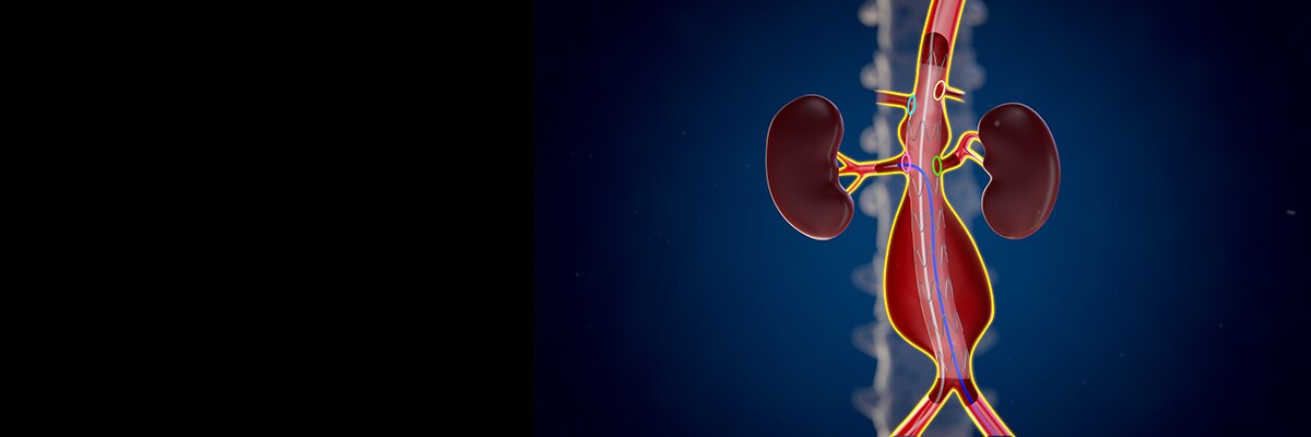 EVAR ASSIST | GE Healthcare (United Kingdom)