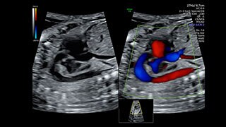 Voluson E6 - Voluson - Ultrasound - Categories | GE HealthCare (United ...