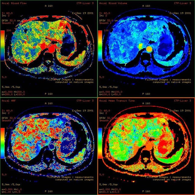 GE Healthcare CT Perfusion 4D Multi Organ